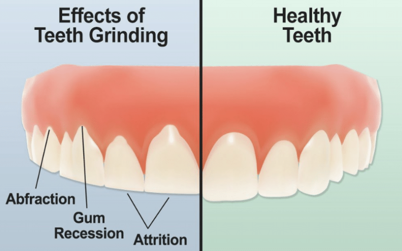 Do I Grind My Teeth? - Radiant Dental